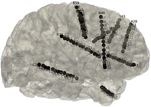 Pediatric Epilepsy Treatment Detroit, MI | DMC Children's